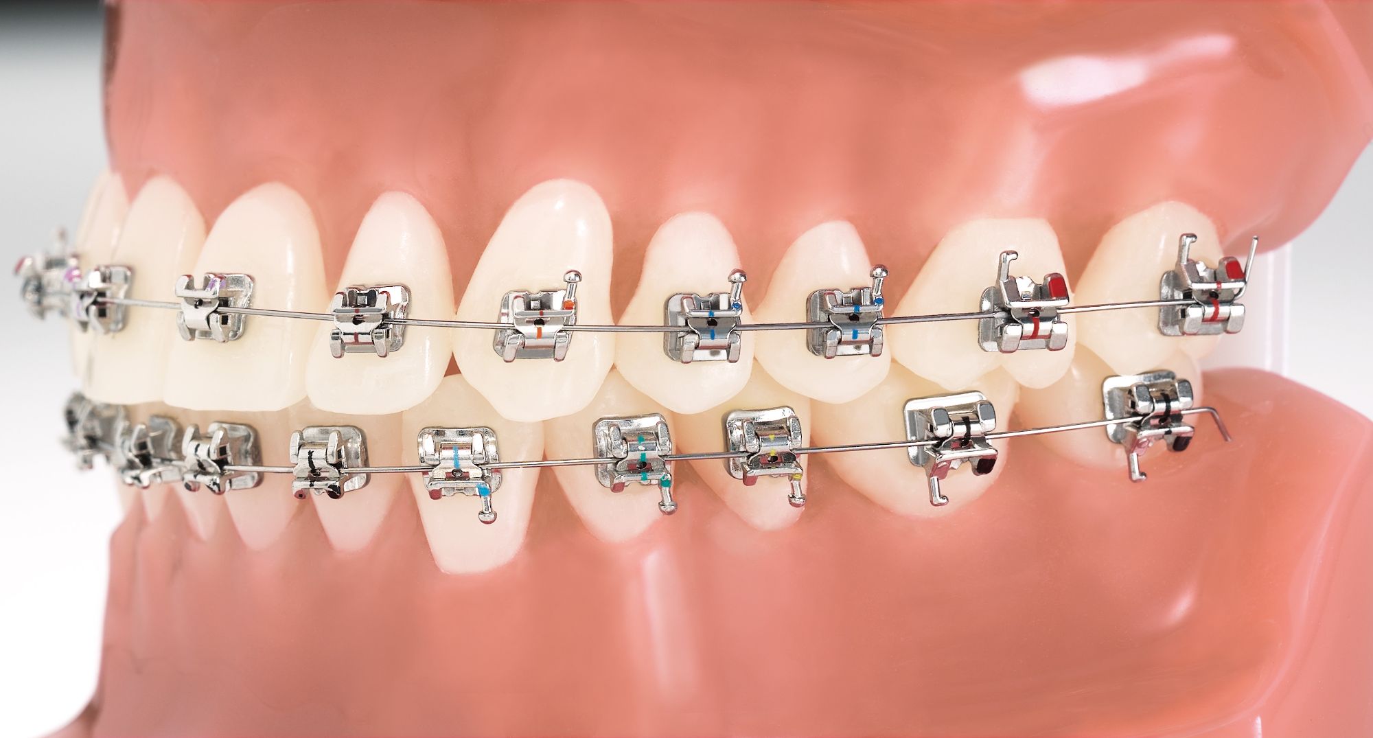 Advanced Metal Braces - Austin Orthodontics - Dr. Briggs