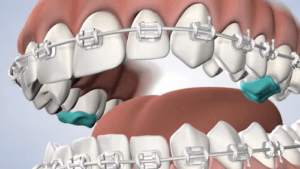 What are Bite Turbos? - Austin Orthodontics