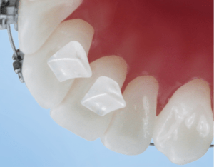 What are Bite Turbos? - Austin Orthodontics